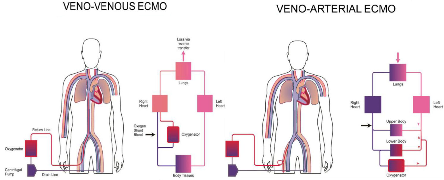 اکمو - the nursing station اکسیژندهی غشایی خارج بدن - ECMO